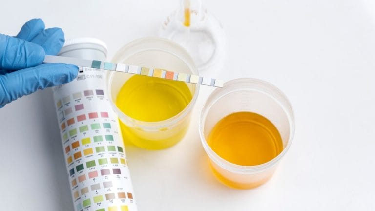 Mengenal Perbedaan Warna Urine Normal dan Abnormal