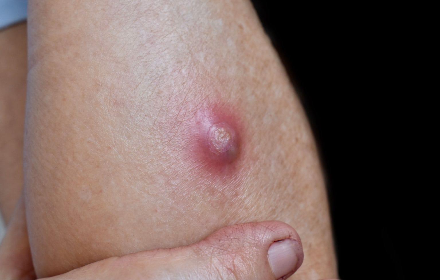 9 Cara Menyembuhkan Bisul agar Cepat Kering dan Kempes