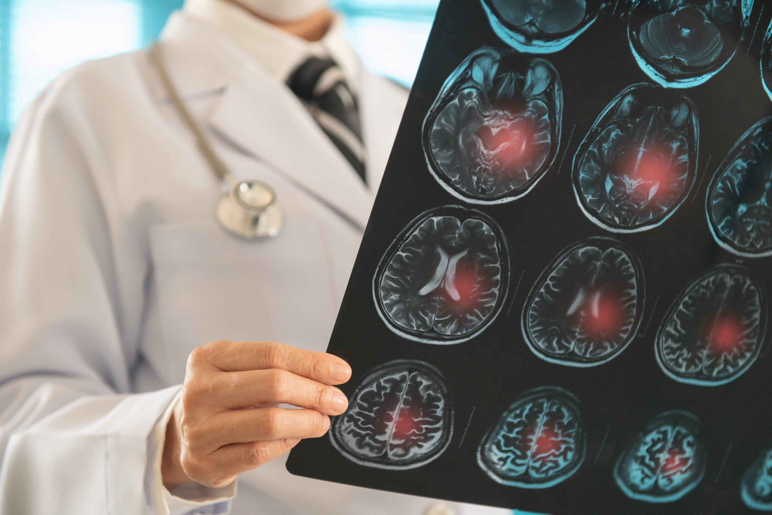 Abses Otak: Gejala, Penyebab, dan Pengobatan