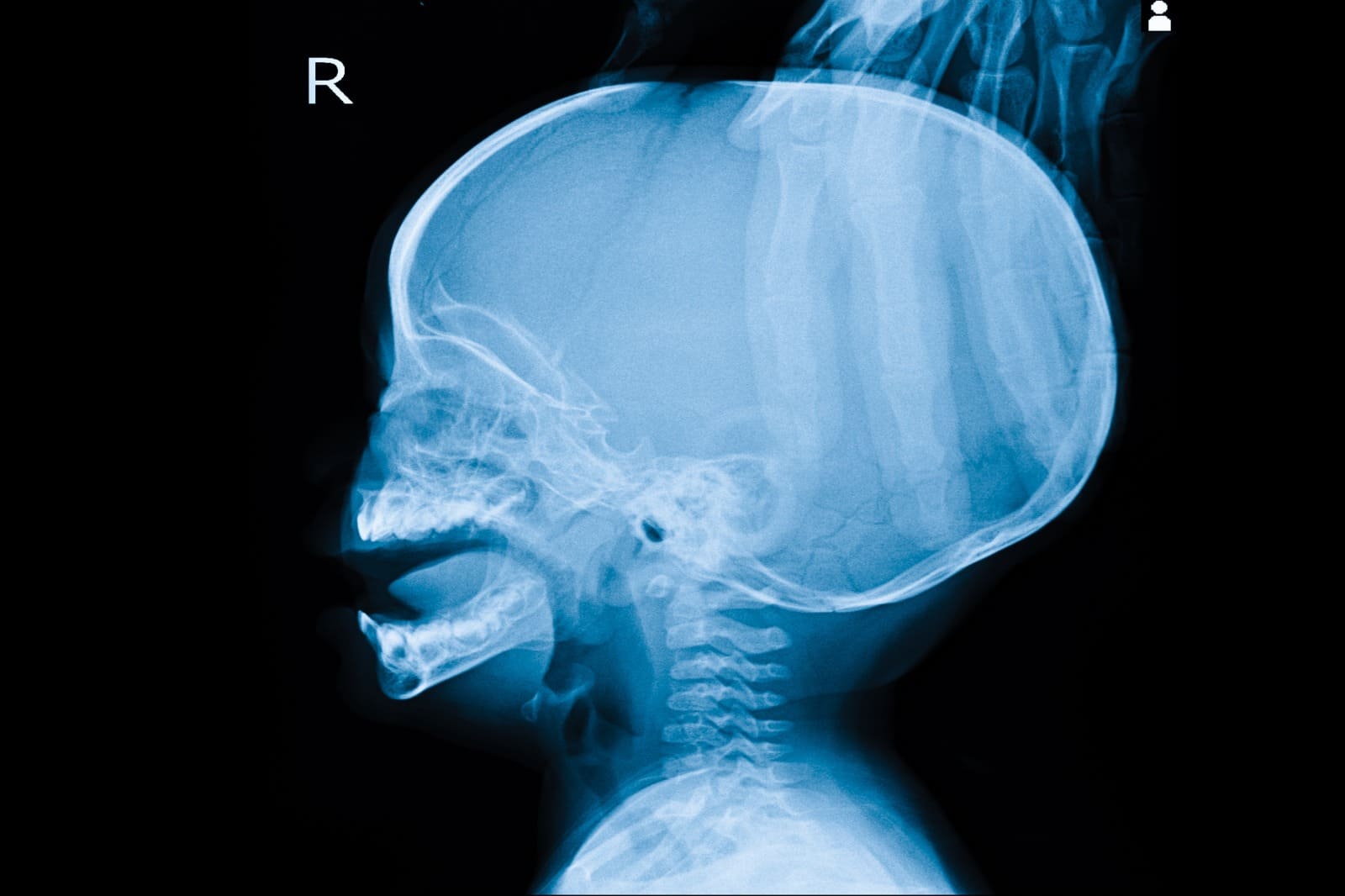 Hidrosefalus: Penyebab, Gejala, Pengobatan