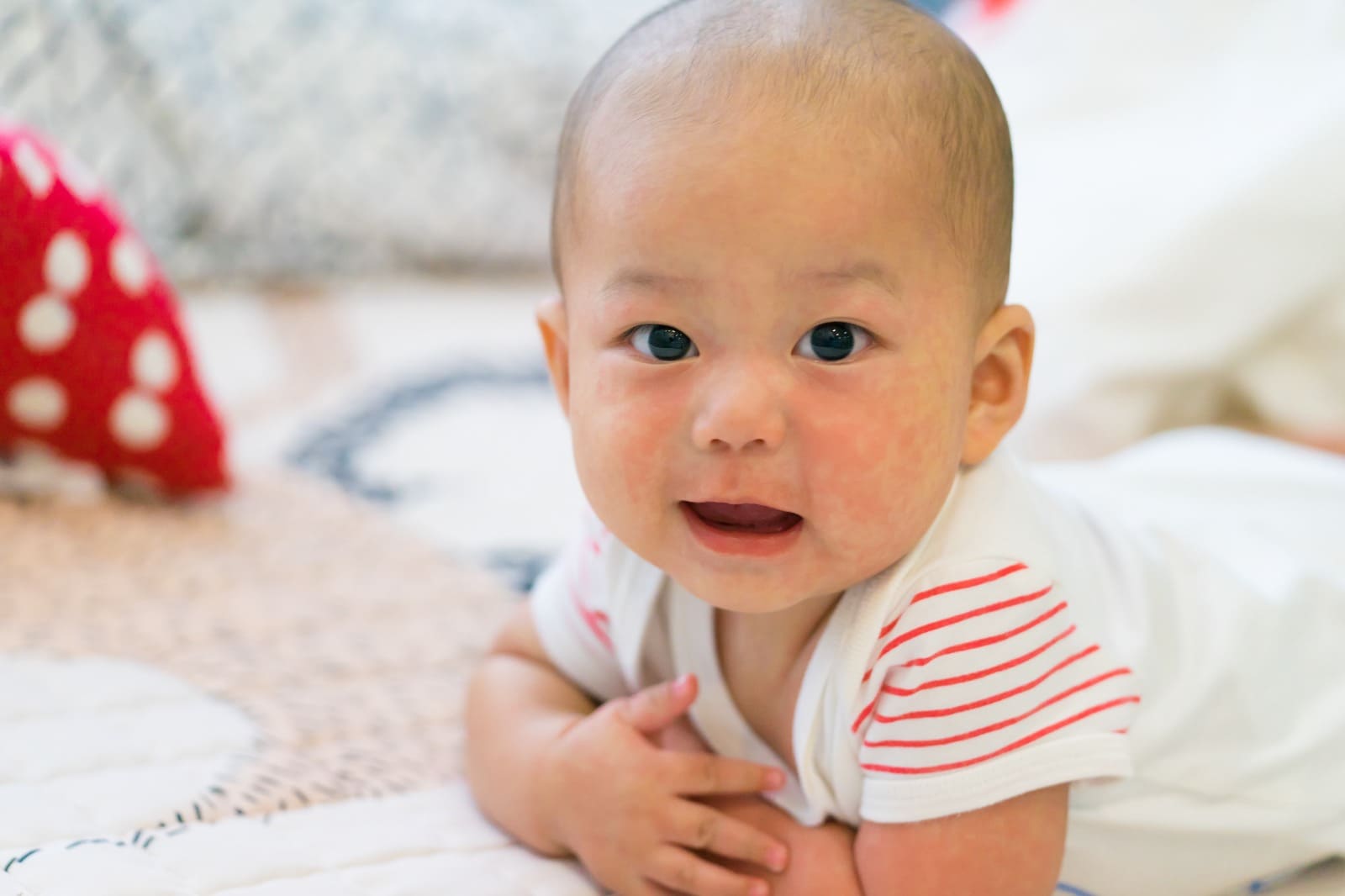Waspada Campak pada Bayi: Kenali Gejala & Pengobatannya