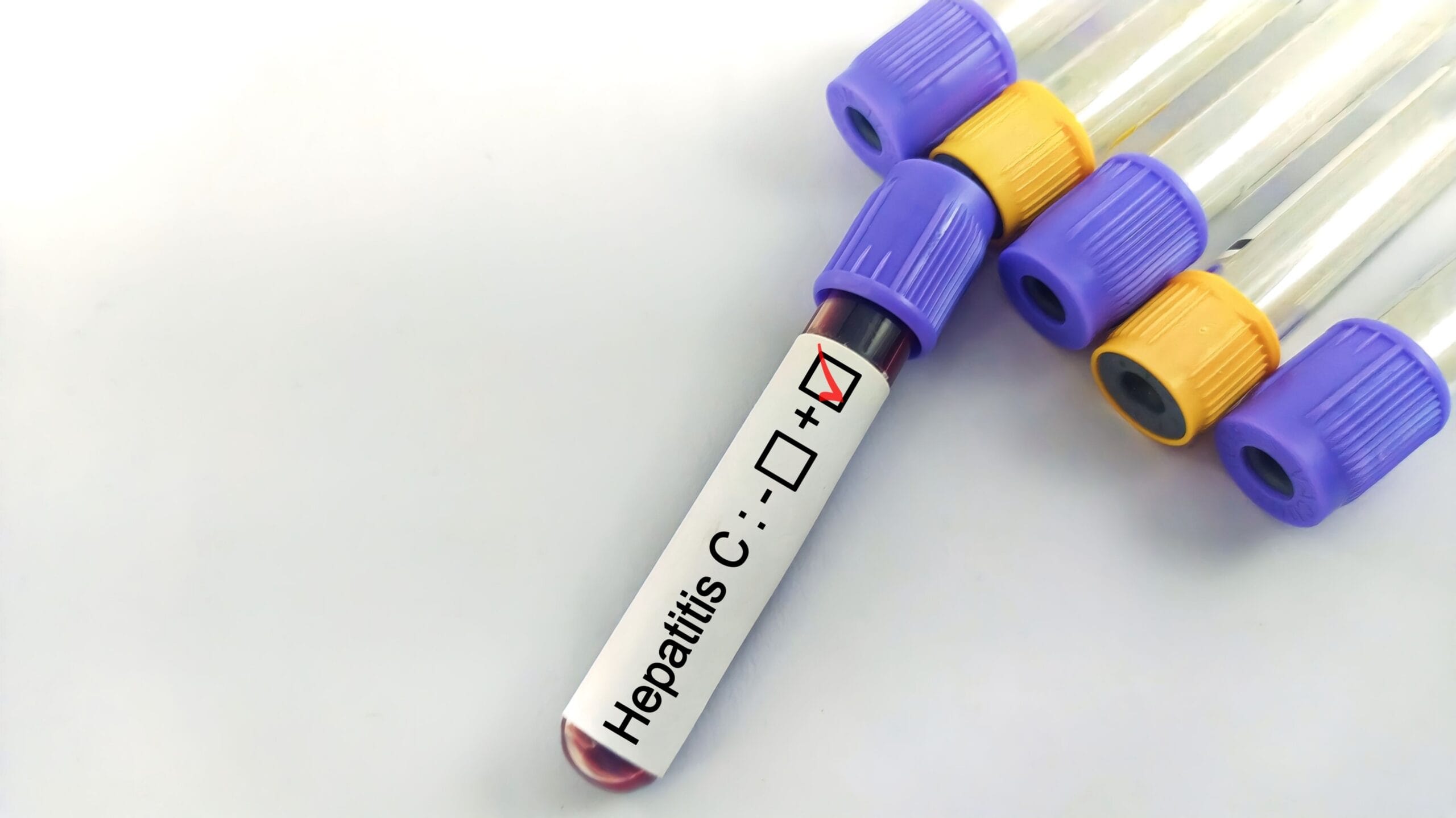 Hepatitis C: Gejala, Penyebab, Pengobatan, Pencegahan