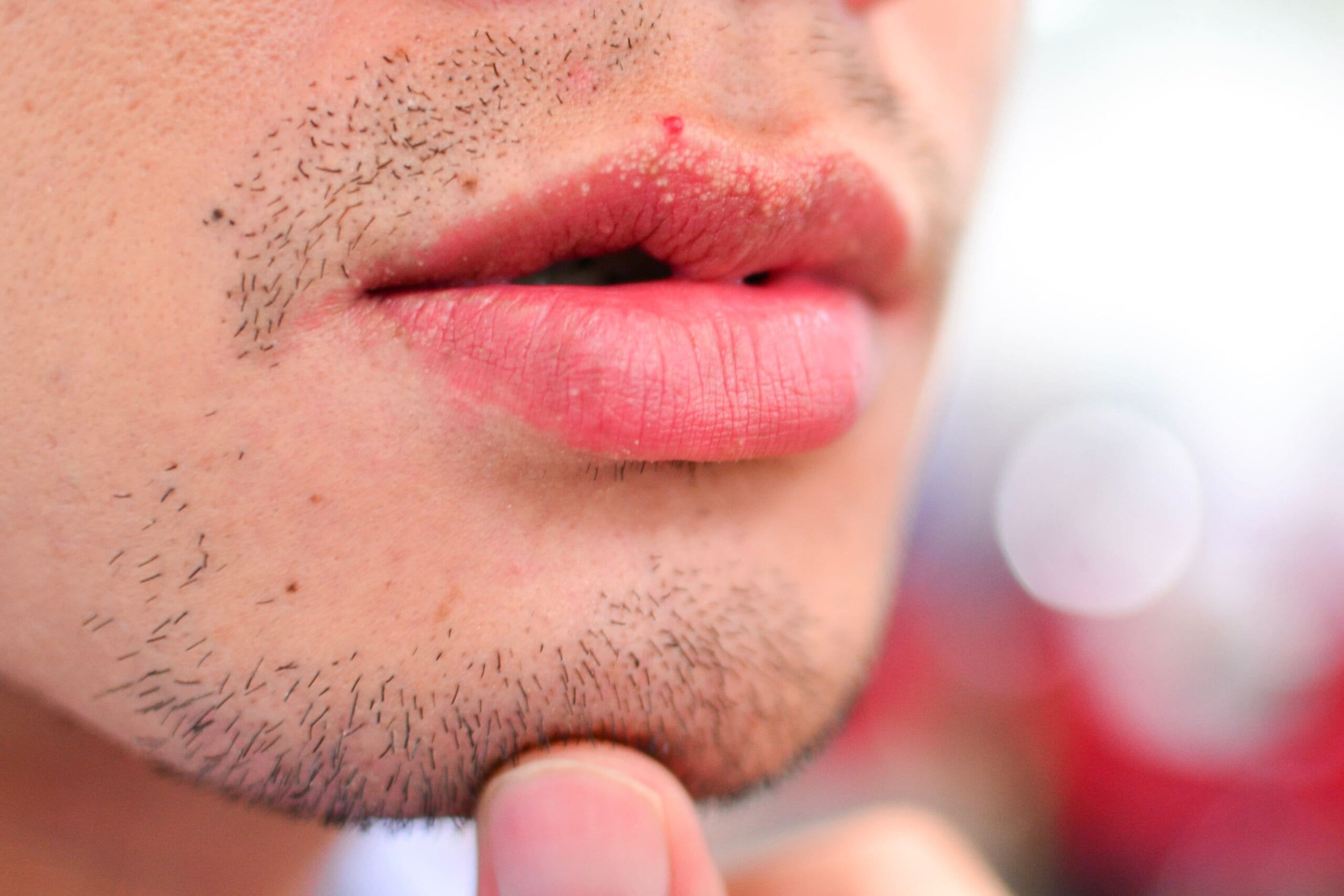 Mengenal Fordyce Spots (Bintik Putih pada Bibir)