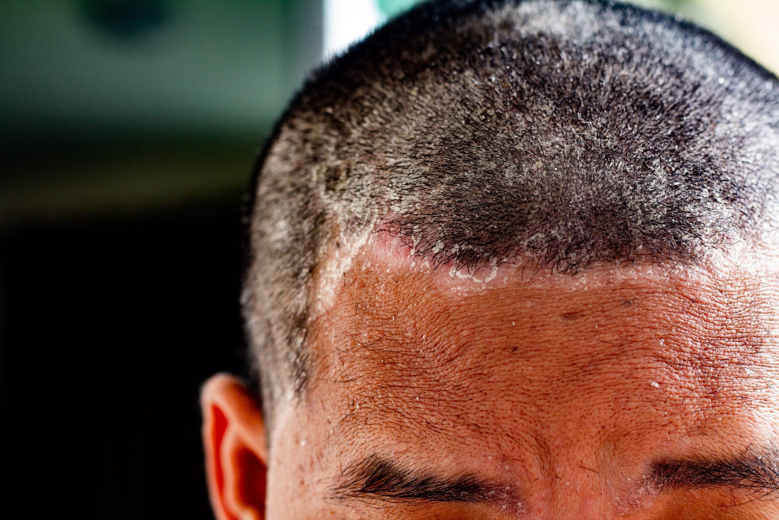 Tinea Capitis: Penyebab, Gejala, Pengobatan